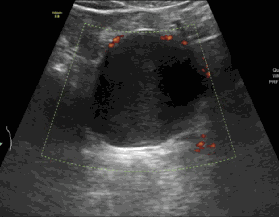 Torbiele endometrialne - pierwszy namacalny objaw endometriozy ...